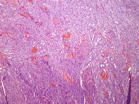 Nodular Kaposis Sarcoma Dermatopathology