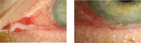 Persistent Corneal Defect In Chronic Progressive External
