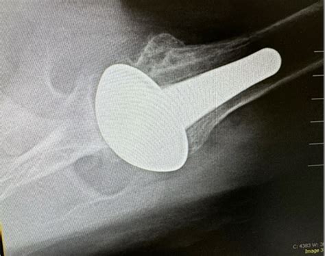 Uw Shoulder And Elbow Academy Managing The B2 Glenoid In An Active