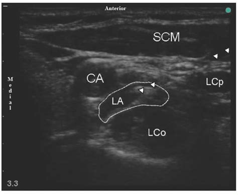 Ultrasound Guided Cervical Sympathetic Block Anesthesia Key