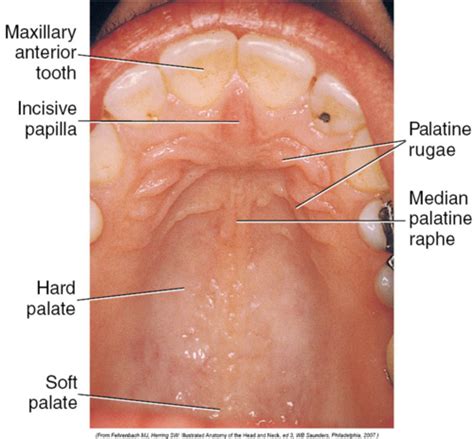 Incisive Papilla Inflammation