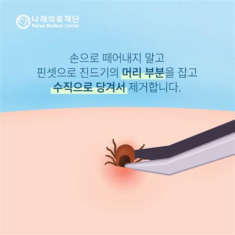 진드기 물렸을때 물린자국 쯔쯔가무시sfts 증상과 치료 네이버 블로그 진드기 물렸을때 물린자국 쯔쯔가무시sfts 증상과 치료 네이버 블로그