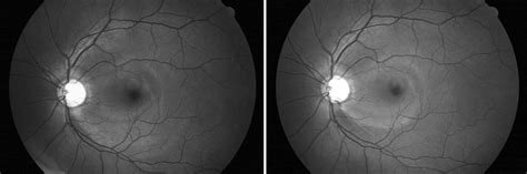 Nerve Fiber Layer Defects Imaging In Glaucoma Intechopen