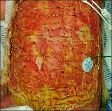 Biodegradable Temporizing Matrix Utilization On A Pediatric Burn Following An Exploratory