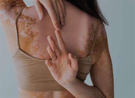 Non Cancerous Lesions Skin Benign Growth On Skin Rtwskin