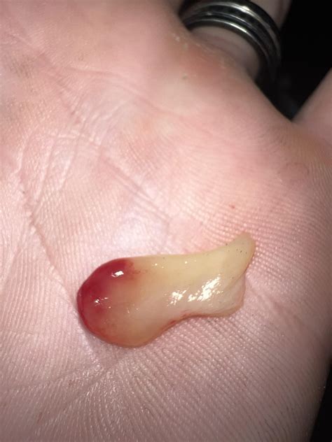 Blew A Polyp Out Of My Nose Rpopping