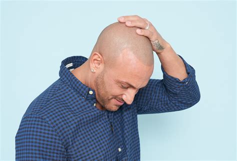 What Is DHT And How Does It Impact Hair Loss Scalp Micro USA