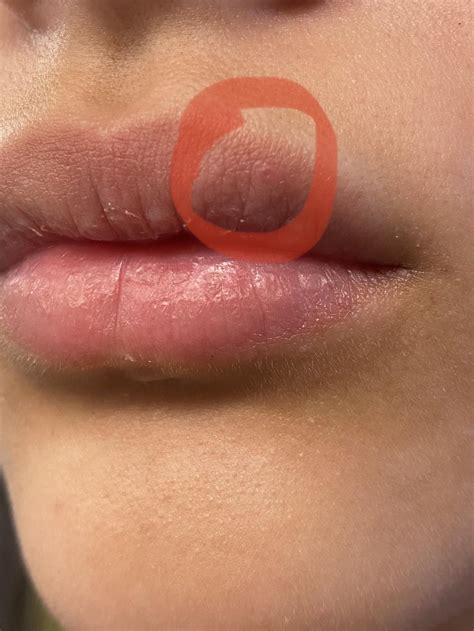 Tiny Bump On My Lip Is It A Cold Sore Rmedicaladvice