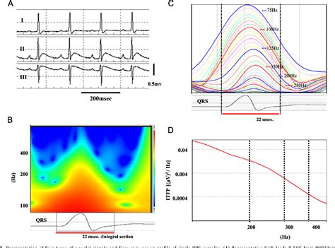 Figure 2 From Time Frequency Power Profile Of Qrs Complex Obtained With