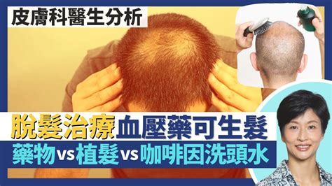 脫髮治療法｜降血壓藥醫甩頭髮 生髮是副作用！？男士脫髮口服藥vs外用藥vs植髮vs咖啡因洗頭水效用分析！女性脫髮較難醫治？｜王建芳醫生 皮膚科