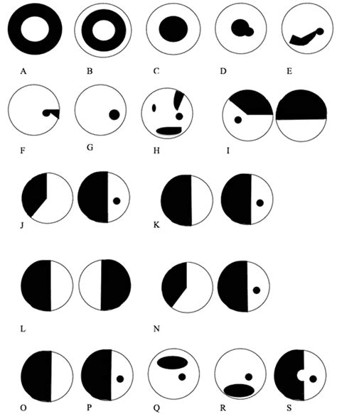 Glaucoma Vision Loss Pattern