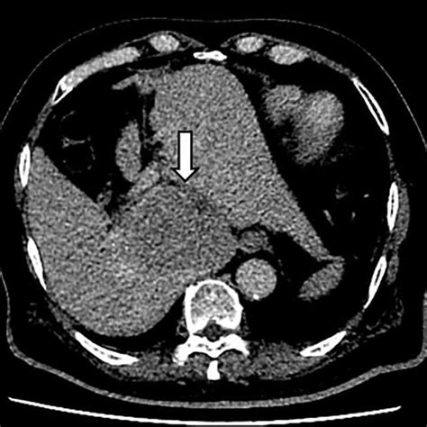 Ct Scan Axial Section Delayed Phase Showing A 32 × 30 Cm Lesion Download Scientific Diagram