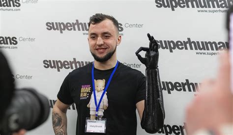 Беруть найскладніші випадки Як переселенцям безкоштовно отримати надсучасні протези