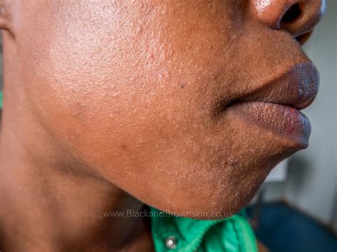 Eczema Rash On Black Skin At Fred Morales Blog
