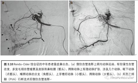 脑血管造影读片基础图谱——颈内动脉、颈外动脉、主动脉弓 脑医汇