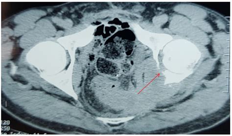 Bone Metastases Of Urothelial Carcinoma