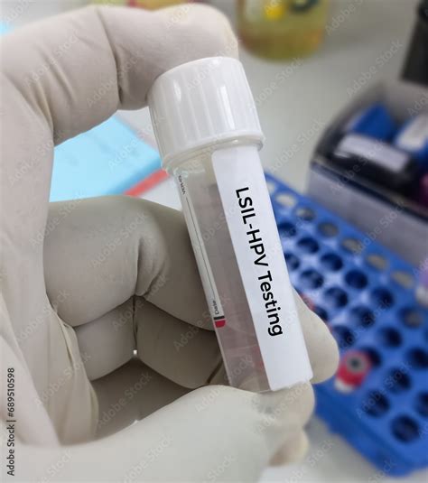 Vaginal Fluid Sample For LSIL HPV DNA Test Human Papilloma Virus Cervical Cancer A Medical
