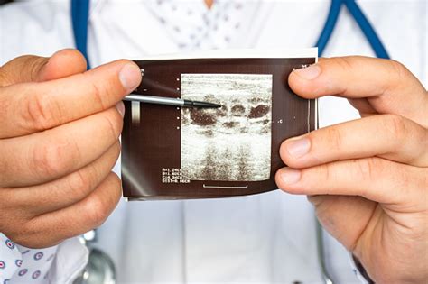 초음파 이미지 개념 사진에 수두 증 수두증과 같은 신장의 초음파 병리학의 인쇄 된 그림에 대한 포인터로 나타내는 의사 진단 방사선학 신장학 수술 콩팥 내부 기관에 대한 스톡