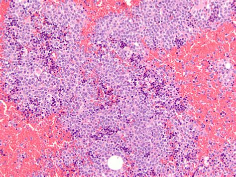 Pathology Outlines Aml With Mutated Runx1