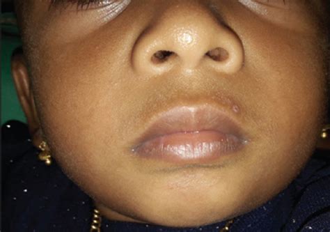 2020217herpessimplex Our Dermatology Online