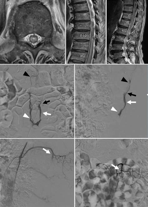 Figure Spinal Magnetic Resonance Imaging And Angiogram A C On