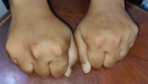 Pseudohypoparathyroidism Types Symptoms And Treatment