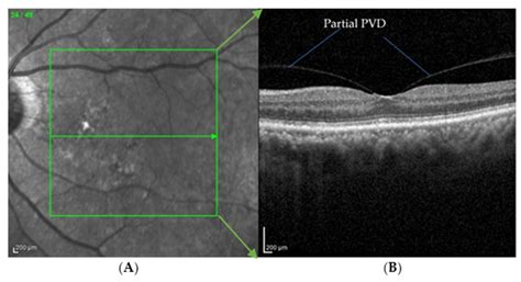 Oct Macula Pvd
