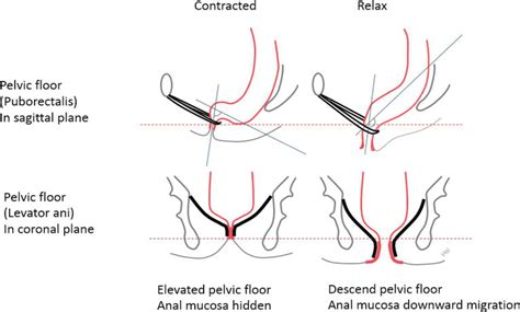 Pelvic Floor Tension Myalgia Causes