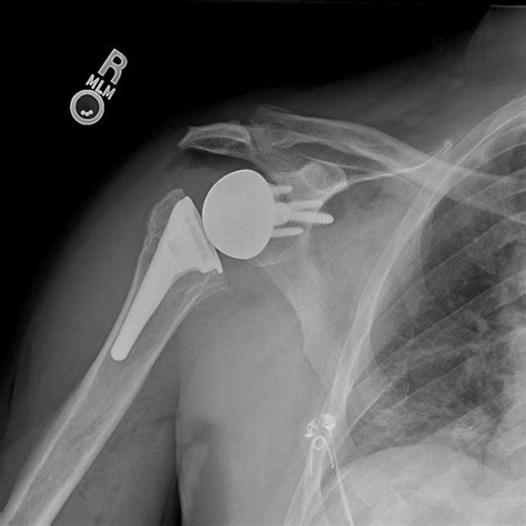 Dr Mcclintocks Shoulder X Ray Image Gallery Kyle Mcclintock Do