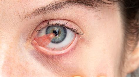 Pterygium — Horta Santini Eyecare