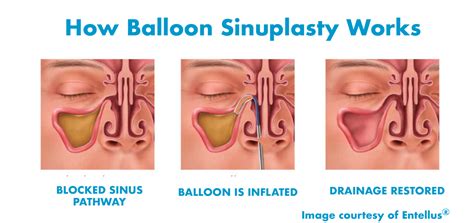 Endoscopic Balloon Dilation Frontal Sinuplasty And Bilateral At Zoe