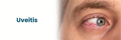 Pictures Of Uveitis Symptoms Causes And Treatments