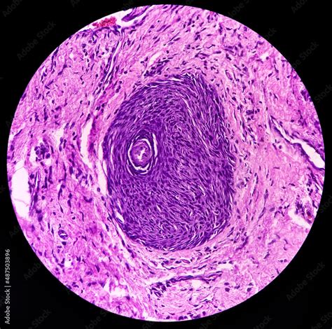 Hidradenoma Papilliferum Benign Skin Tumor Rare Benign Neoplasm