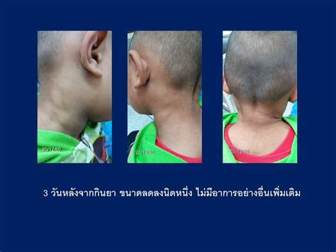 เด็กที่มีต่อมน้ำเหลืองที่คอโต ด คลีนิคแพทย์สนิท ลำปลายมาศ