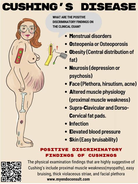 Mnemonic For Cushings Syndrome My Endo Consult
