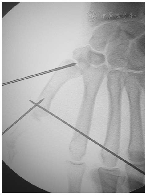 Simultaneous Extraarticular Fracture Of The Base Of The First Metacarpal And Dislocation Of The