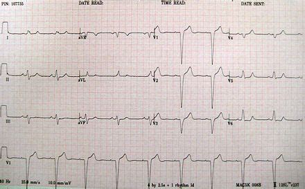 Left Bundle Branch Block Wikipedia