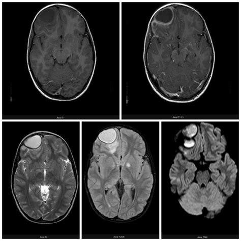 Epidural Abscesses Neuropedia