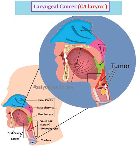 Laryngeal Cancer Treatment In India