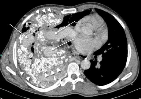 Contrast Enhanced Thoracic Ct Scan Large Aberrant Vessel S In Right