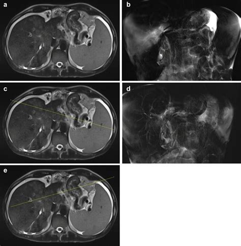 Mrcp Findings Obscured By Ascites 33 Year Old Male With Download
