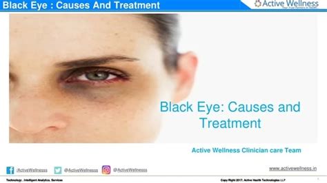 Ppt Black Eye Causes And Treatment Powerpoint Presentation Free