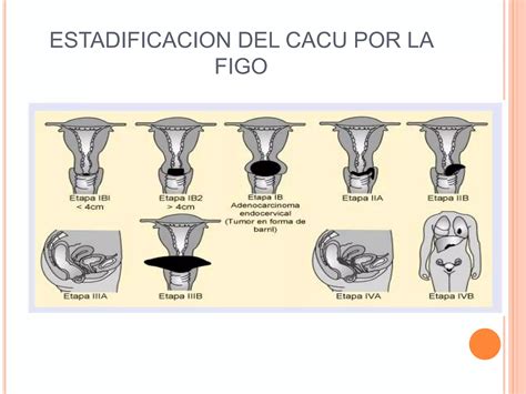 Cancer Cervicouterino Pptx