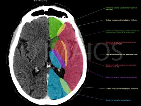 Vasculary Territories Territory Of Middle Cerebral Artery Cortical