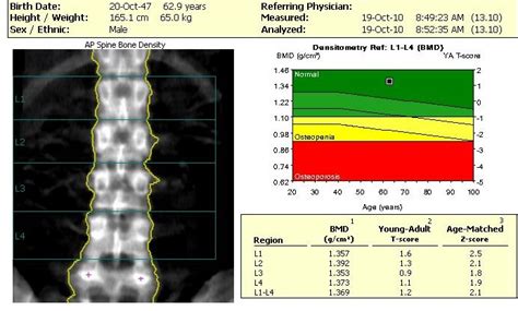 Dxa Scan Anandorthopedic
