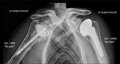 Prostalac Spacer For Infection Boston Shoulder Institute