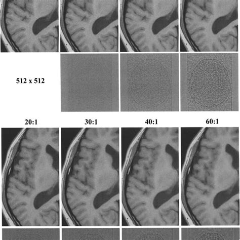 Detection Of Focal Brain Lesions At Mri With Wavelet Compression Download Table