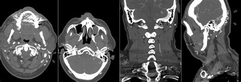 Occipital Dural Arteriovenous Fistula Radiology Imaging