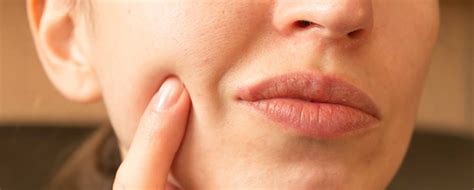 Cold Sores Illustration Different Stages Cold Sores Inflammation Stock