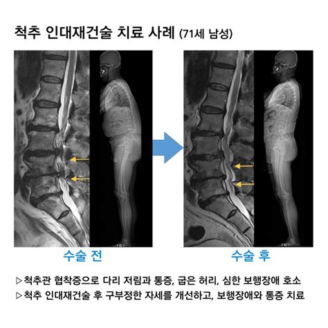 척추관협착증 수술 후 하루 만에 걸으세요